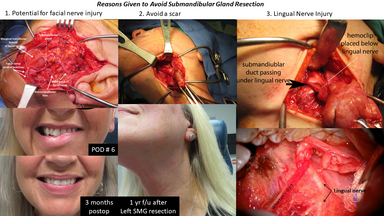 Submandibular Gland Resection Excision Iowa Head And Neck Protocols