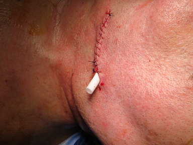 Submandibular Gland Resection/Excision | Iowa Head and Neck Protocols ...