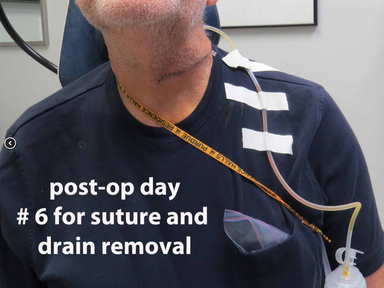 Submandibular Gland Resection/Excision | Iowa Head and Neck Protocols ...