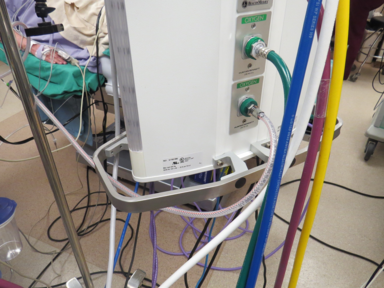 Jet Ventilation Anesthesia - Transoral for Laryngeal Surgery | Iowa ...