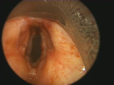 Anterior Glottic Web | Iowa Head and Neck Protocols - Carver College of ...