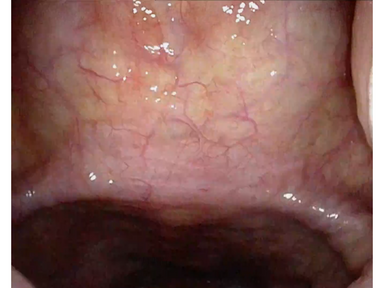 Passavant's Ridge (Passavant's Pad) and Velopharyngeal Incompetence ...