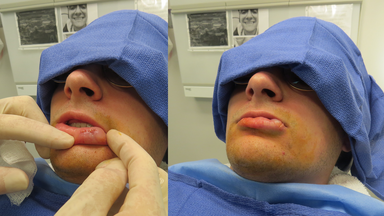 Lower Lip Bump (Mucocele versus Mucus Retention Cyst) Minor Salivary ...