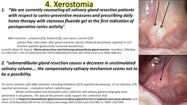 Submandibular Gland Resection/Excision | Iowa Head and Neck Protocols ...