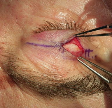 Platinum-Gold Eyelid Weighting | Iowa Head and Neck Protocols - Carver ...